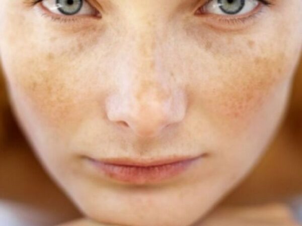 Tipos de manchas en la piel con fotos | Mujer | Mujer con salud